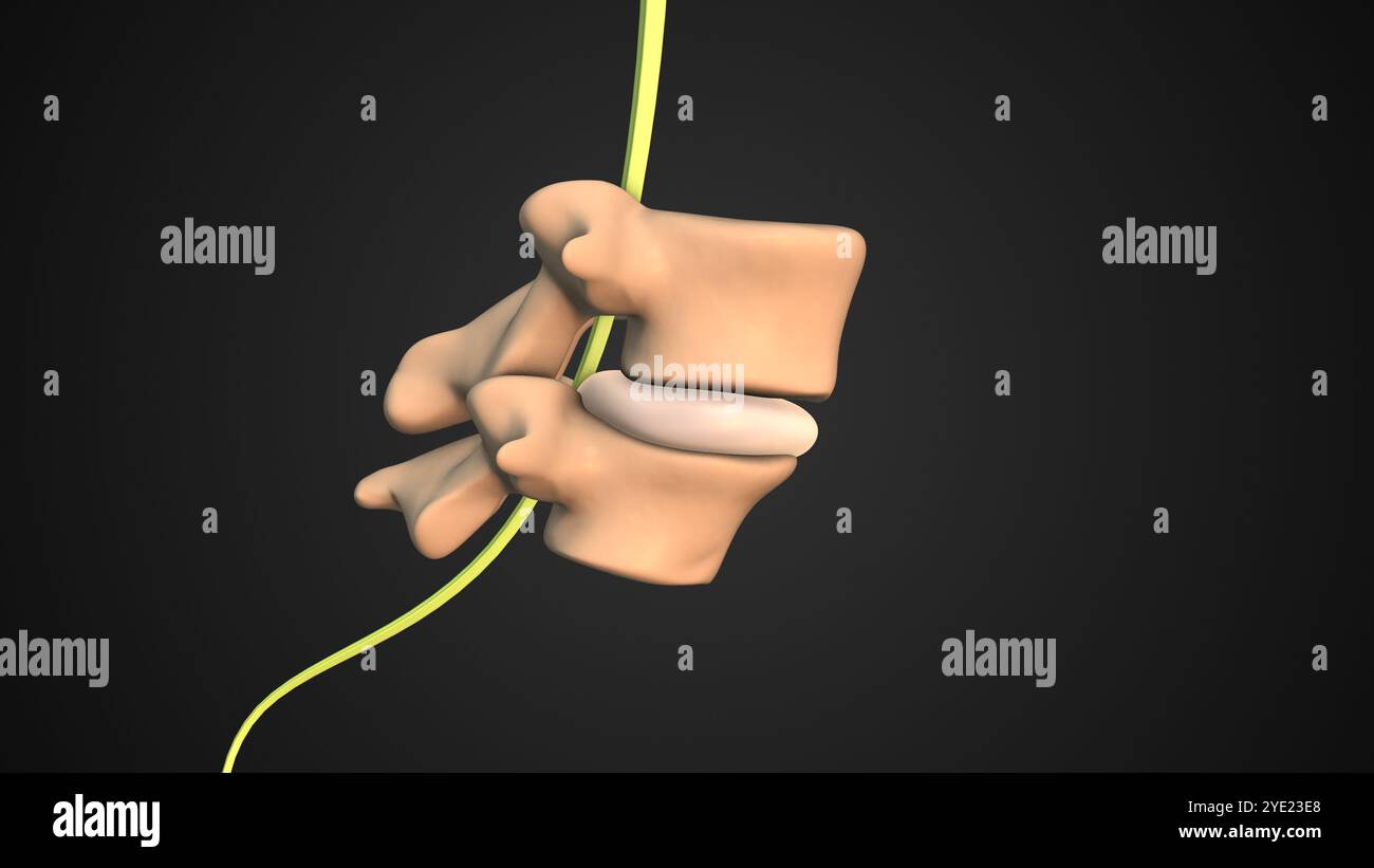 Vertebral Slippage Resulting in Spondylolisthesis Symptoms Stock Photo ...