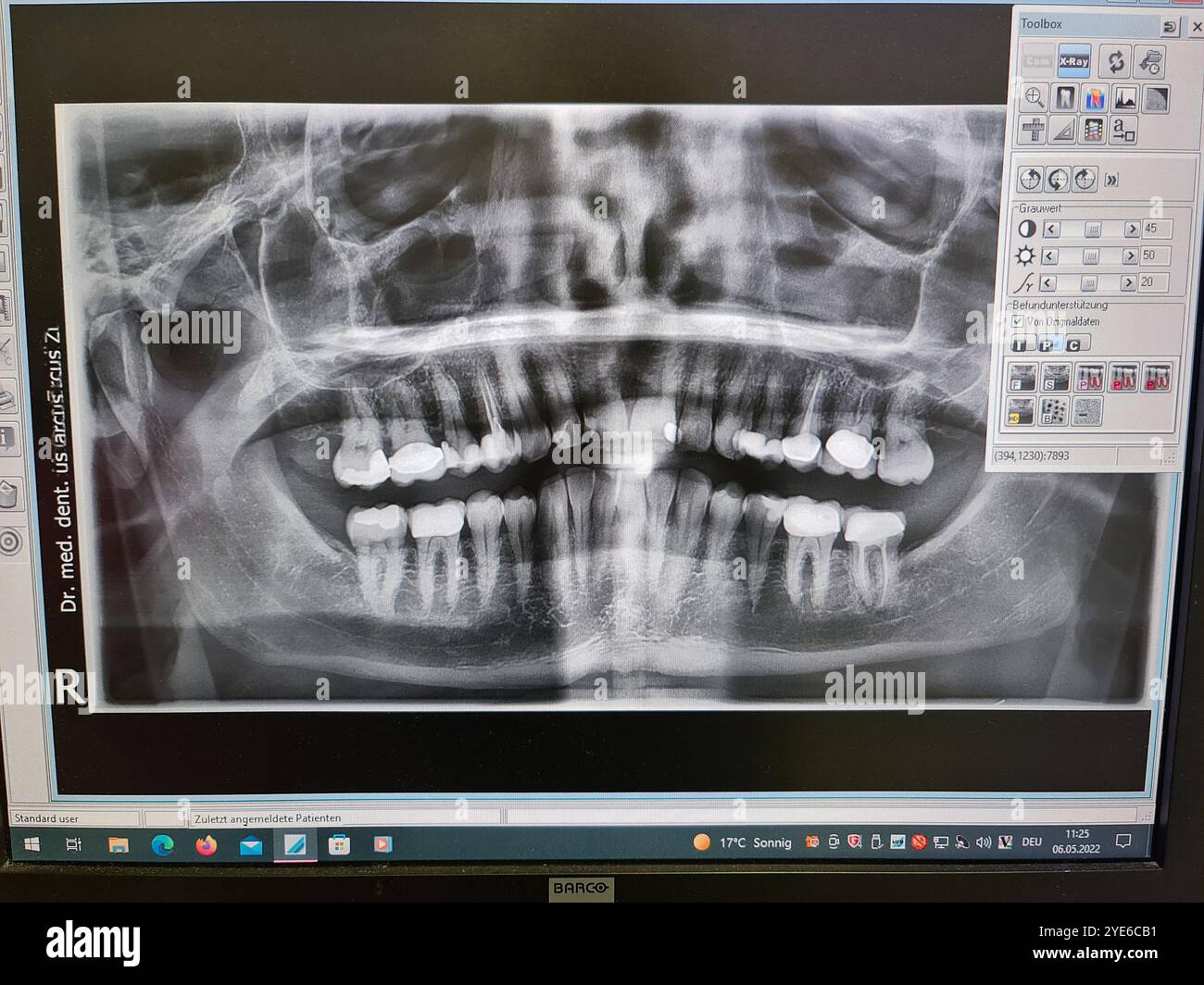 X-ray of the teeth, panoramic image of the entire teeth in the upper ...