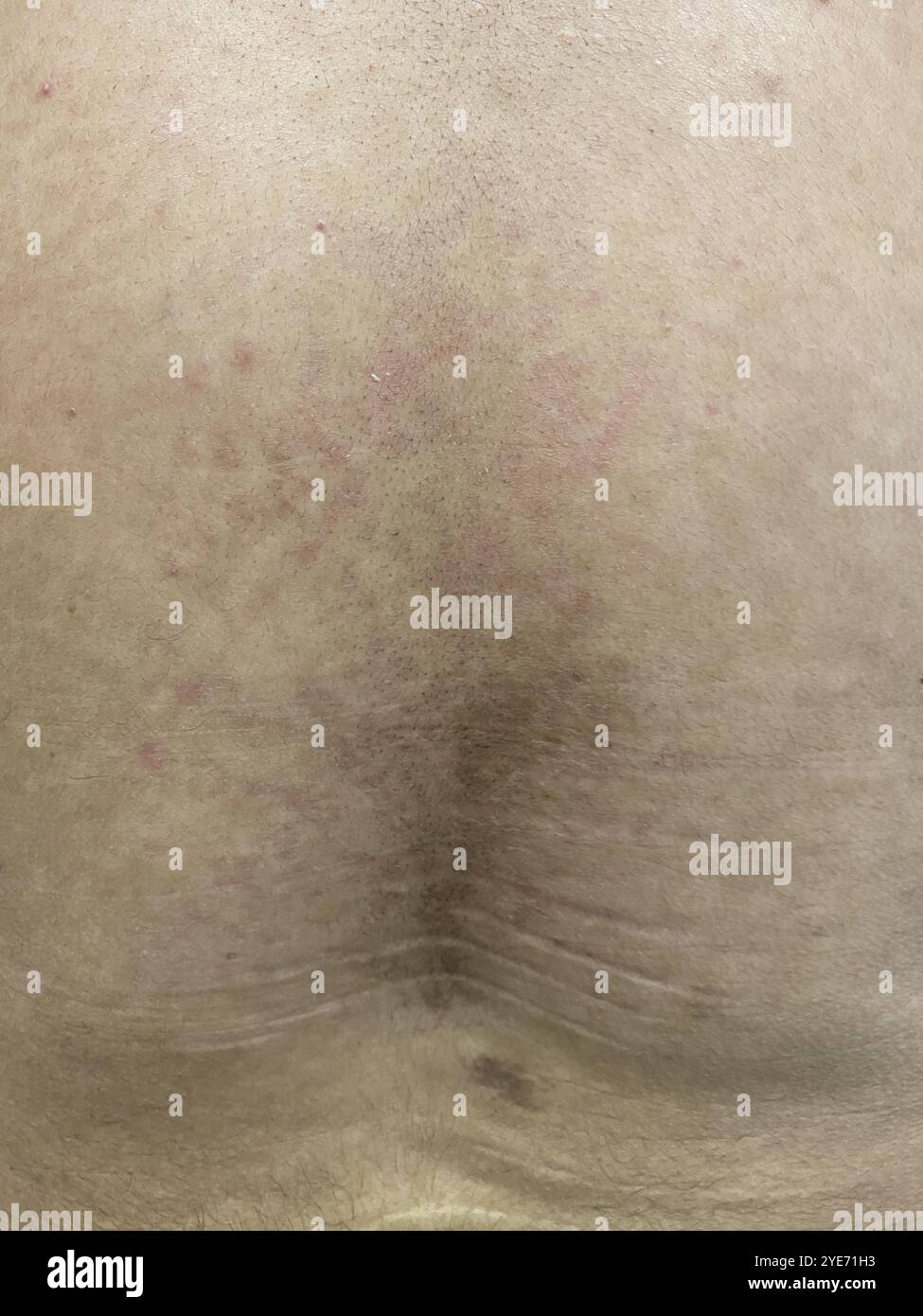 Confluent and reticulated papillomatosis on a patient's skin. This rare ...