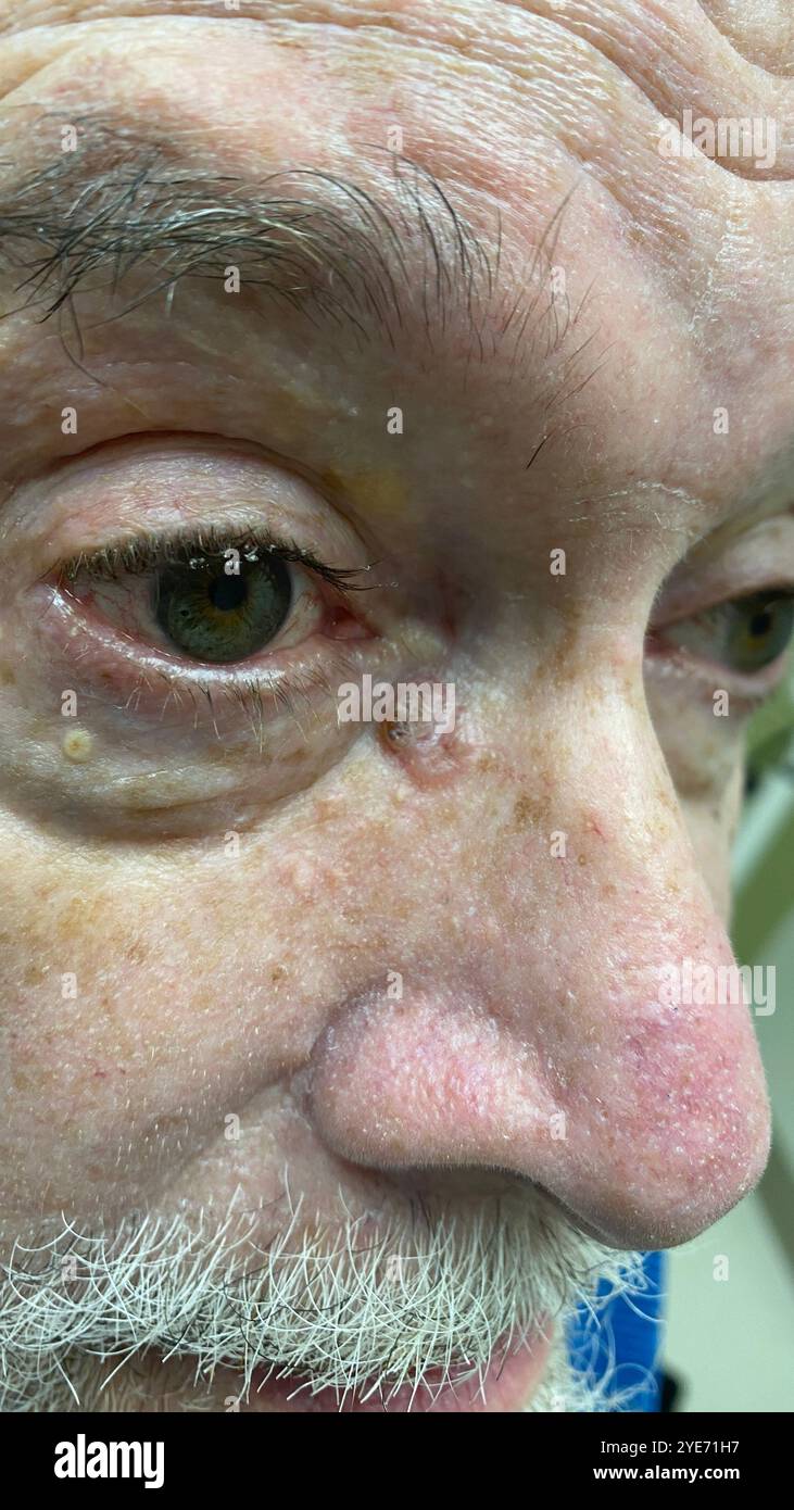 Basal cell carcinoma (BCC), or rodent ulcer, on a male patient's nose ...