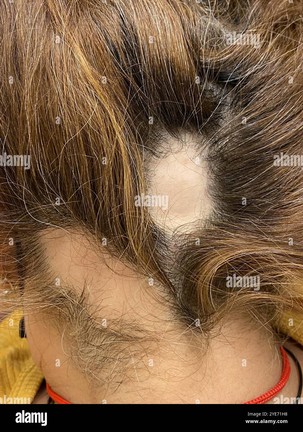 Bald spot on the scalp of a patient with alopecia areata (spot baldness ...