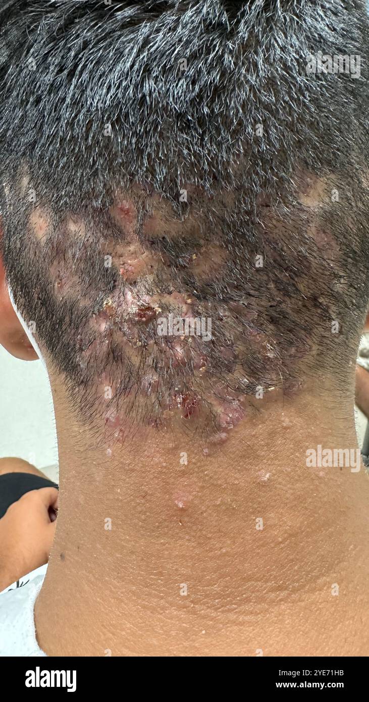 Acne keloidalis nuchae (AKN) on the back of a Hispanic male patient's ...