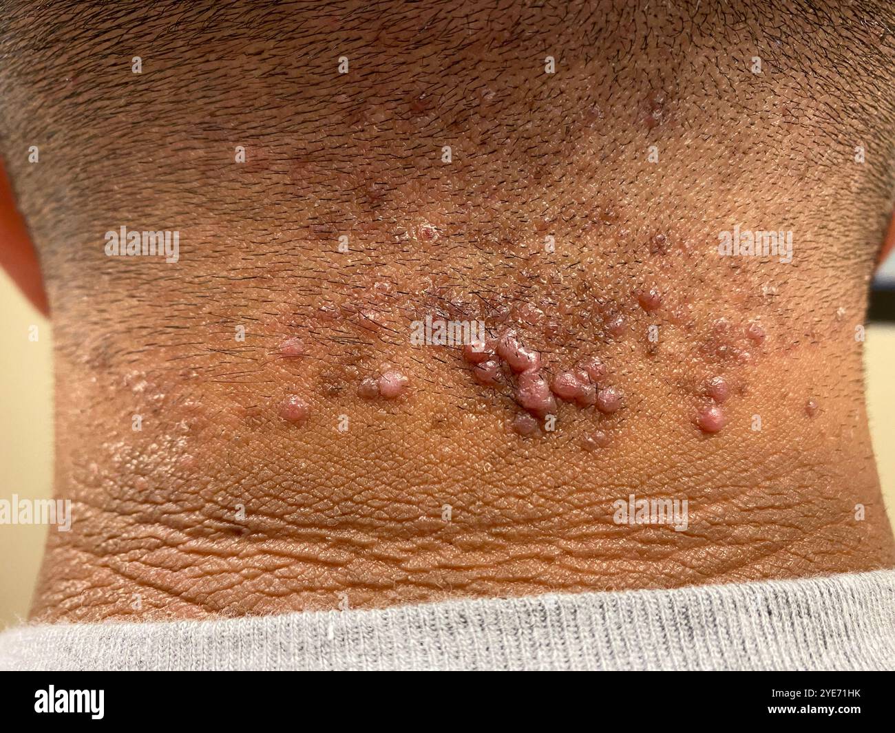Acne keloidalis nuchae (AKN) on the back of a patient's neck. AKN is a ...