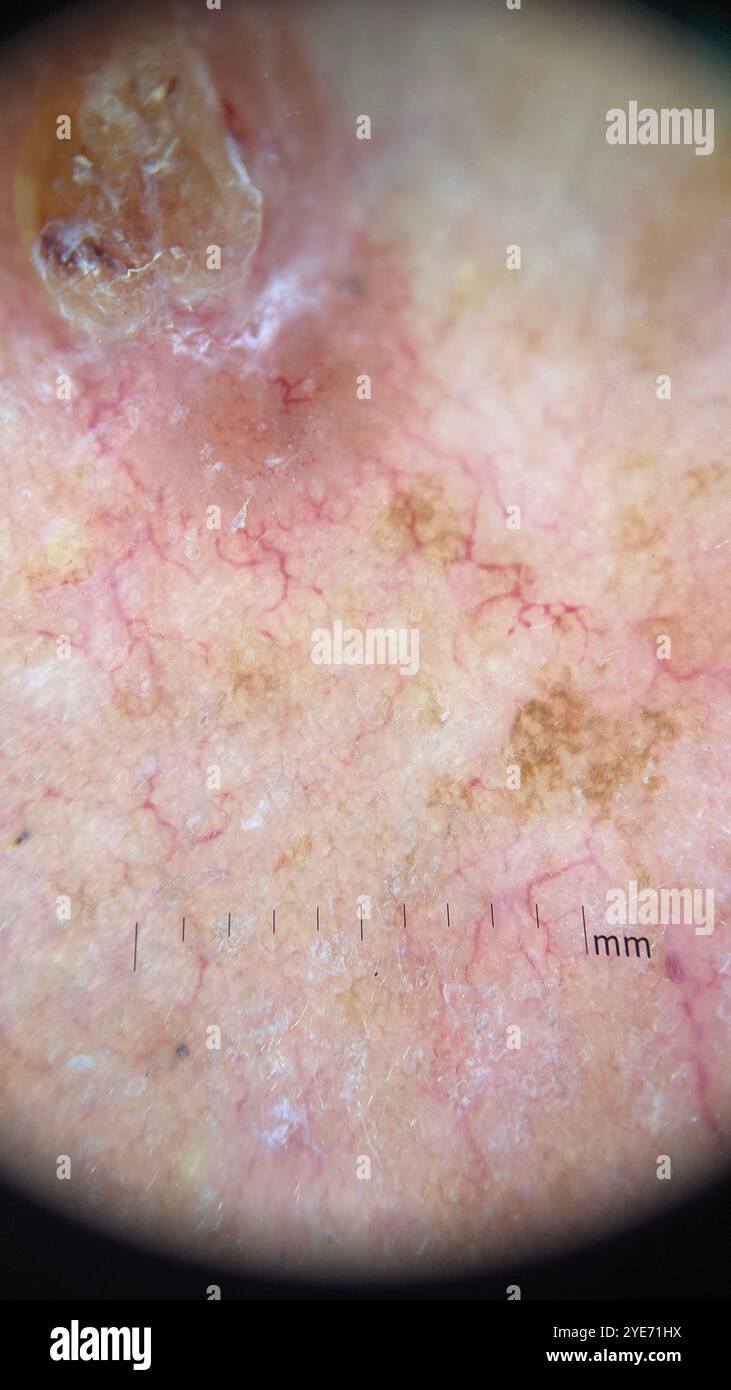 Dermatoscope image of a basal cell carcinoma (BCC), or rodent ulcer, on ...