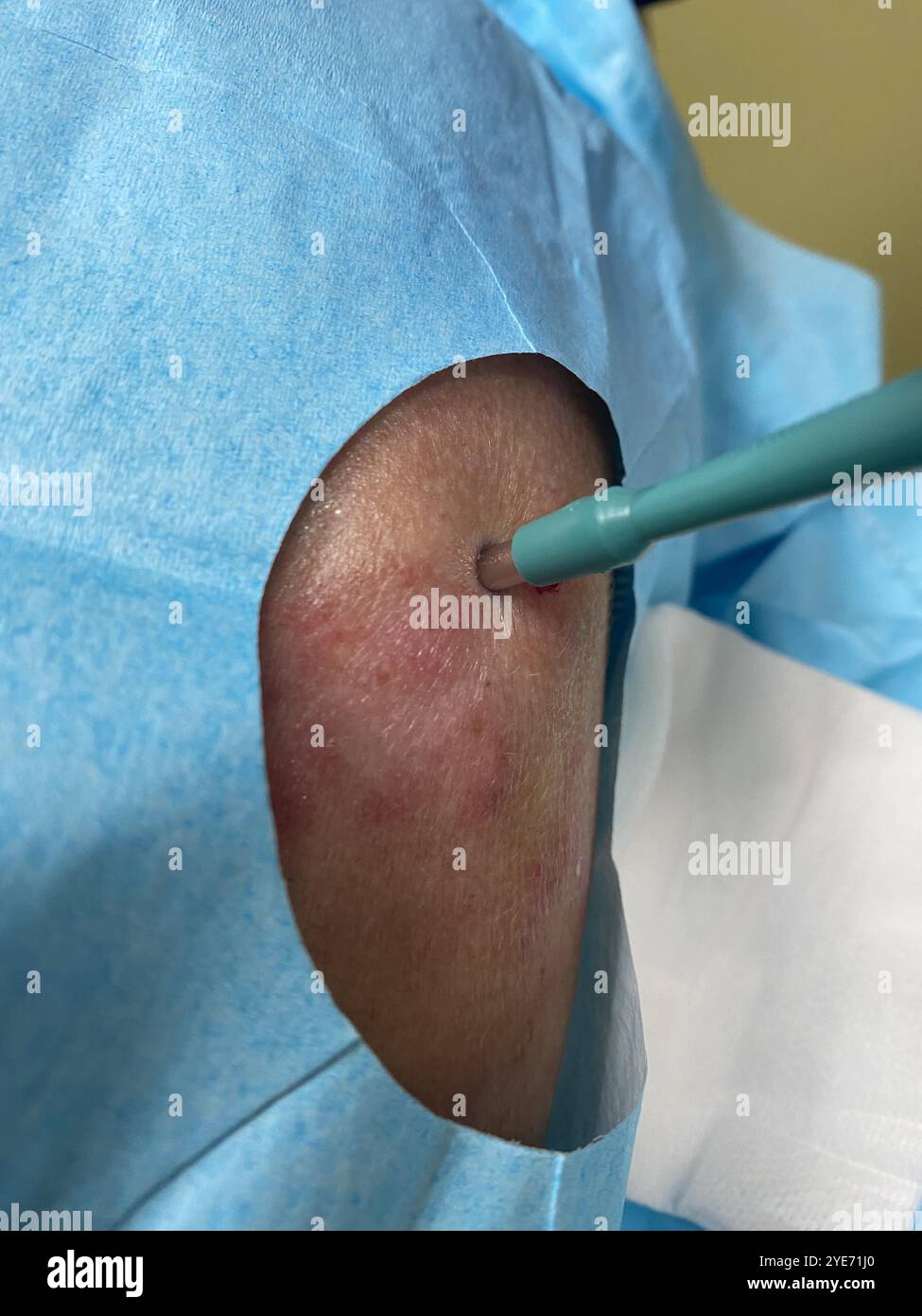 Doctor taking a punch biopsy from the skin of a patient with mycosis ...