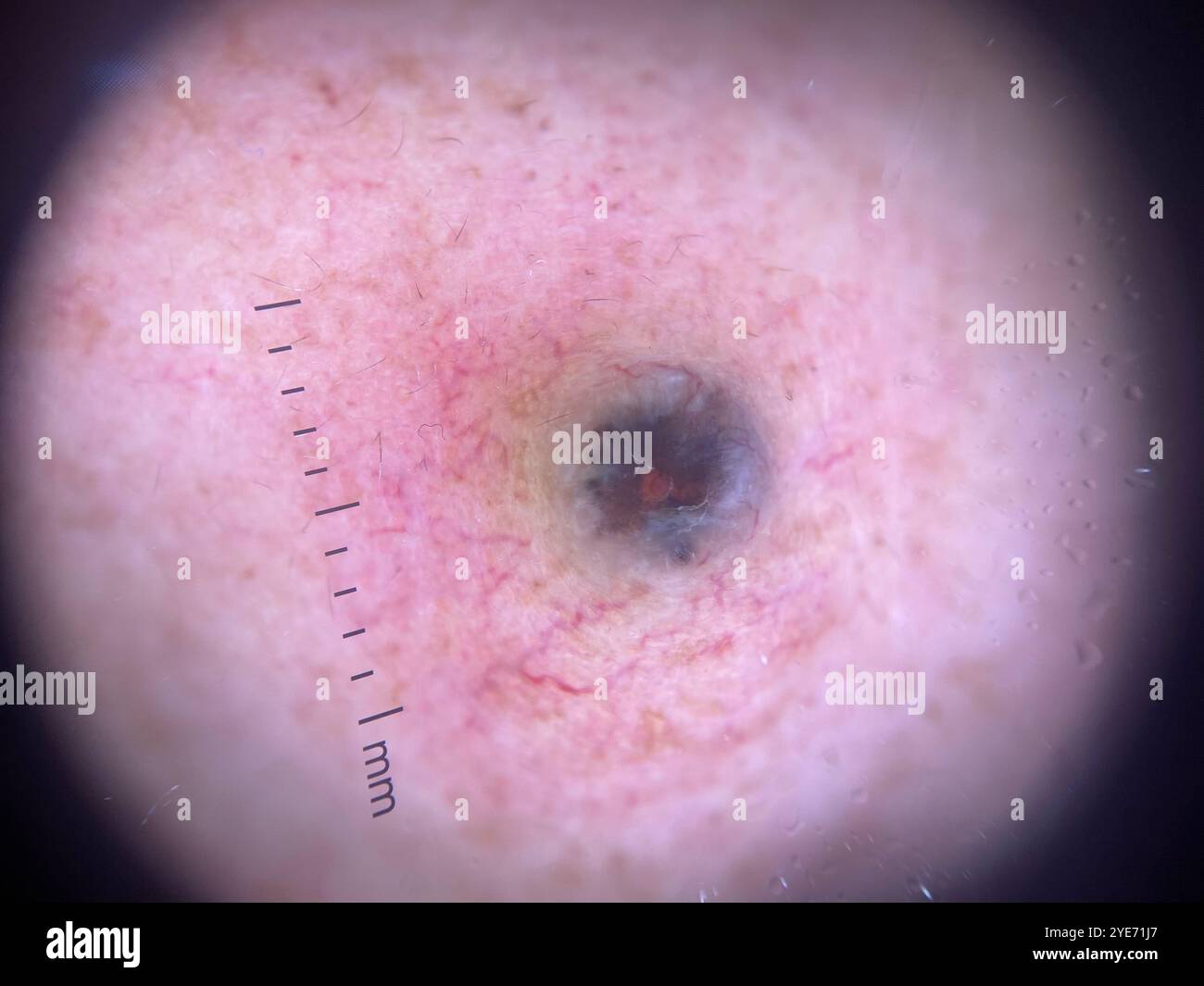 Dermatoscope image of a pigmented basal cell carcinoma (BCC), or rodent ...