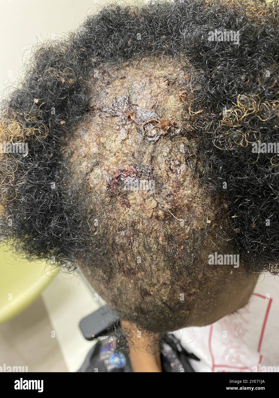 Dissecting cellulitis on an African-American male patient's scalp. This ...