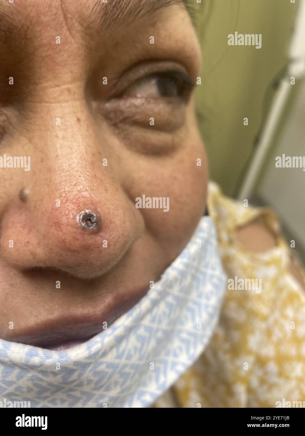 Pigmented basal cell carcinoma (BCC), or rodent ulcer, on a patient's ...