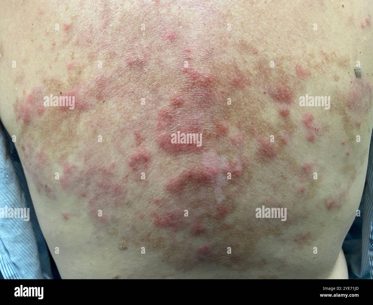 Mycosis fungoides on the back of a 70 year old caucasian woman. Mycosis ...