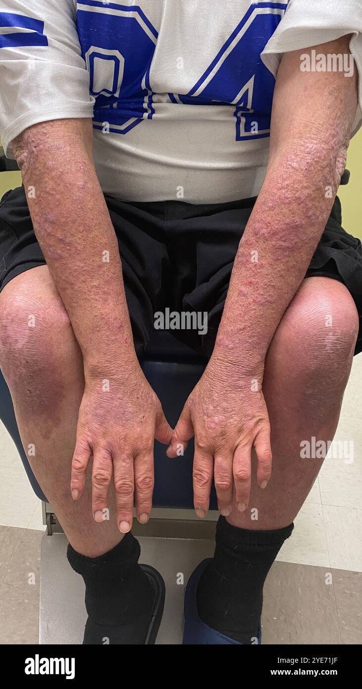 Psoriasis on a patient's arms and legs. Psoriasis is a skin condition ...