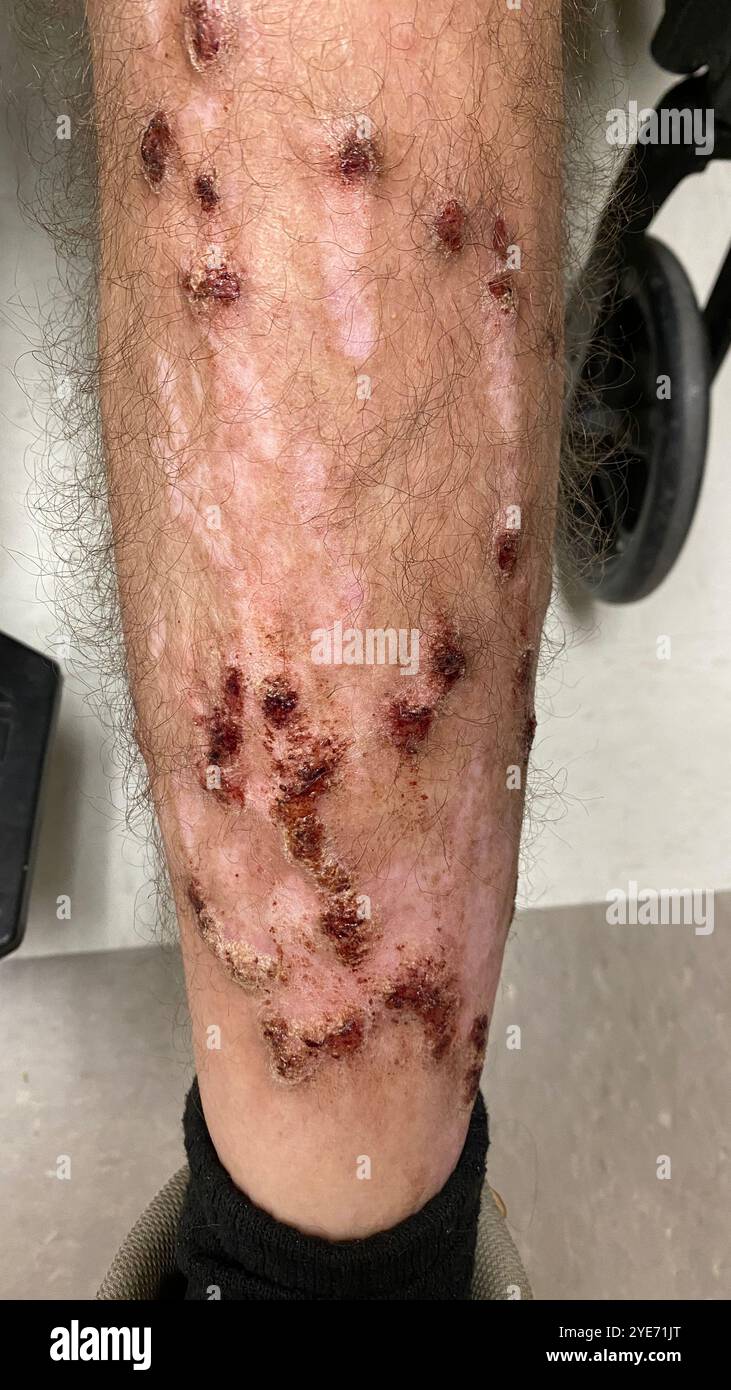 Nodular prurigo on a patient's leg. This condition is characterised by ...