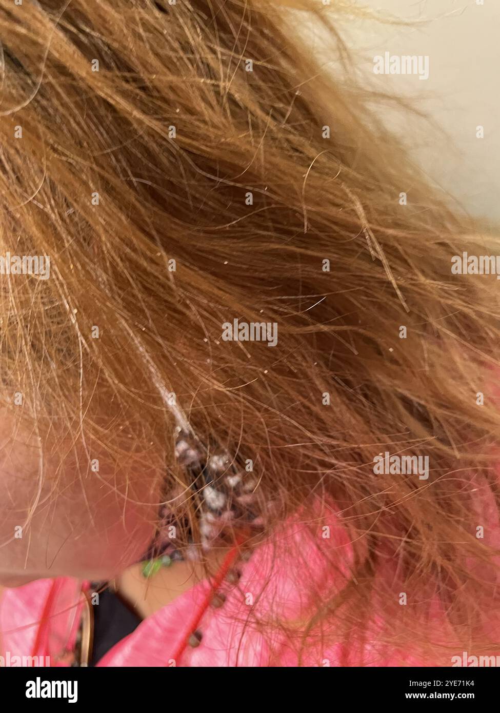 Dead head lice, or nits, in a patients hair. The human head louse ...