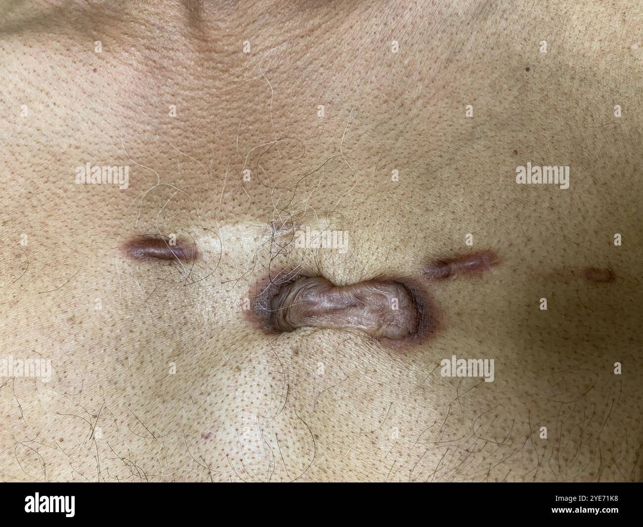 Keloid scars on the chest of a male south Asian patient. A keloid scar ...