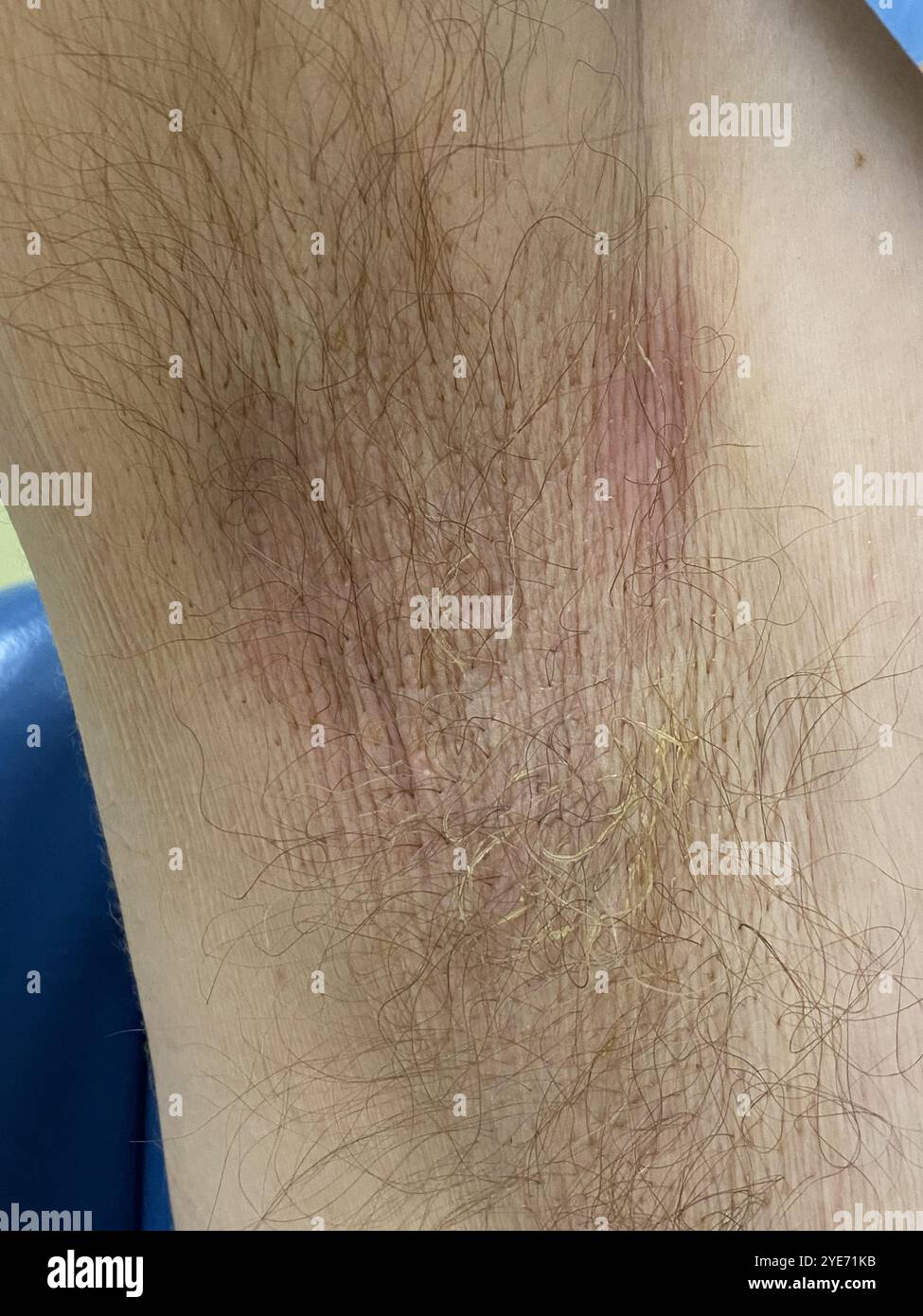 Trichomycosis and erythrasma in the armpit of a 65 year old white male ...