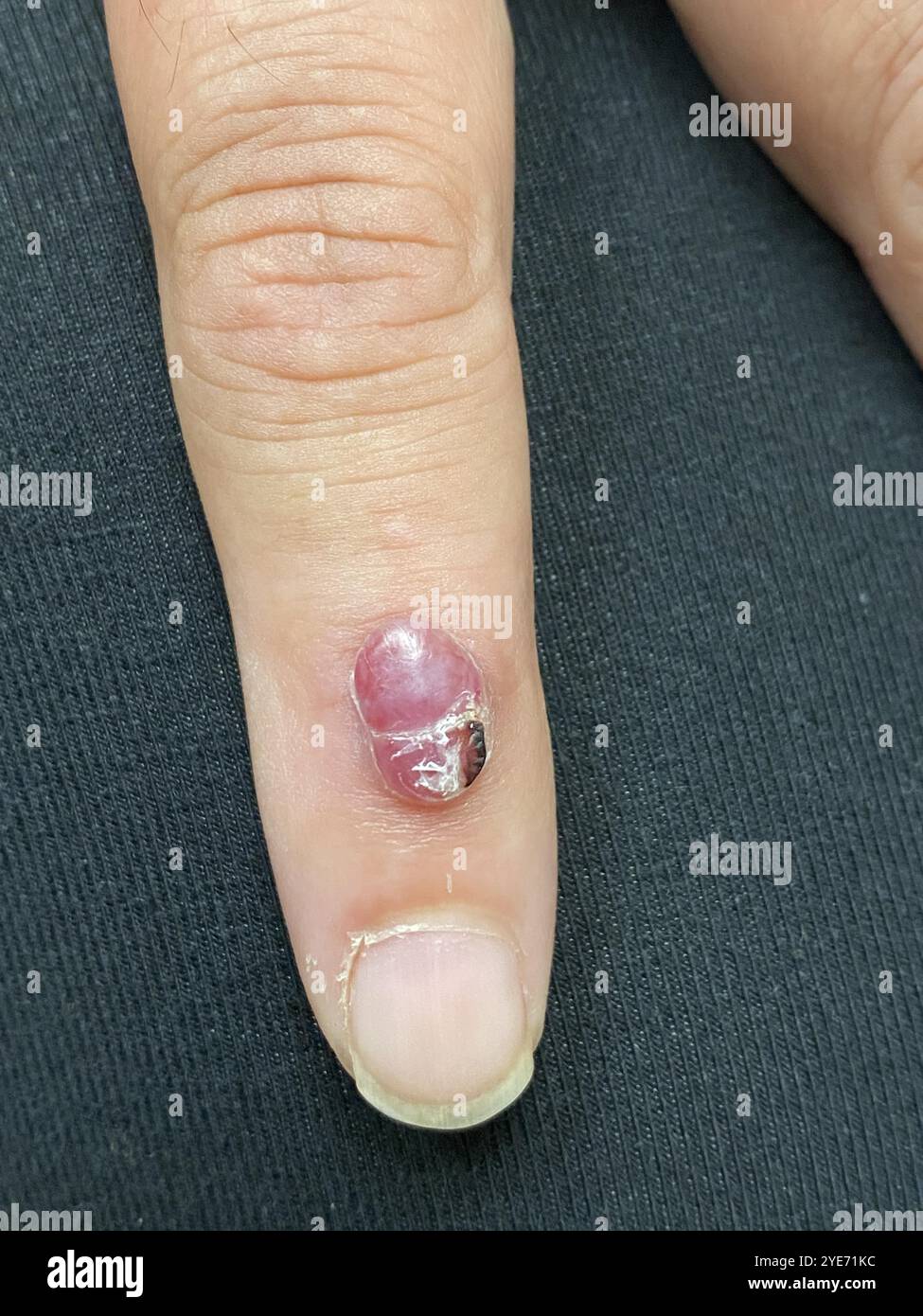 Patient being treated with cryotherapy for pyogenic granuloma. A ...