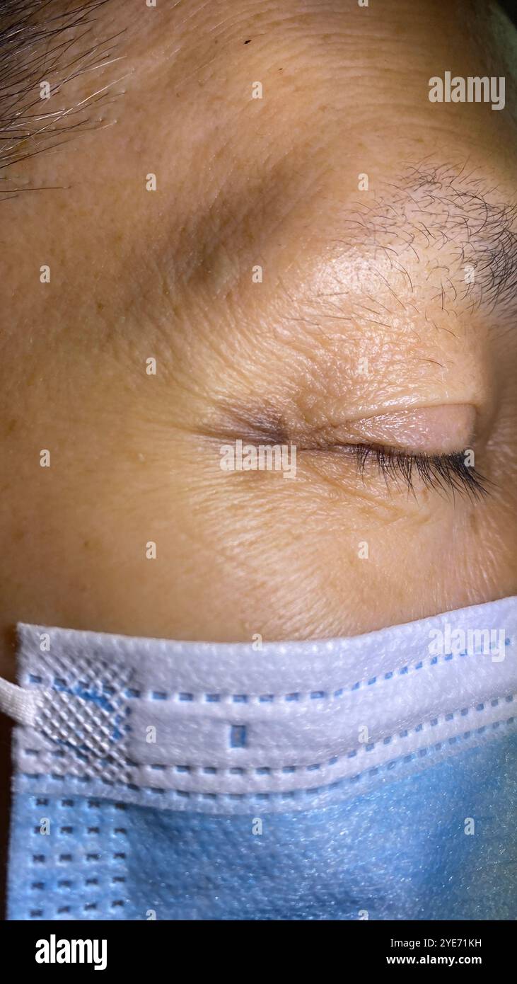 Lichenoid keratosis on a patient's face. This is a benign (non ...