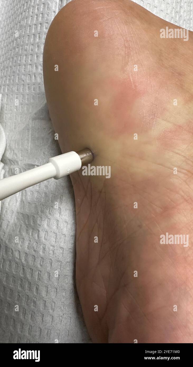 Punch biopsy of a mole on the sole of a patient's foot. This skin mark ...