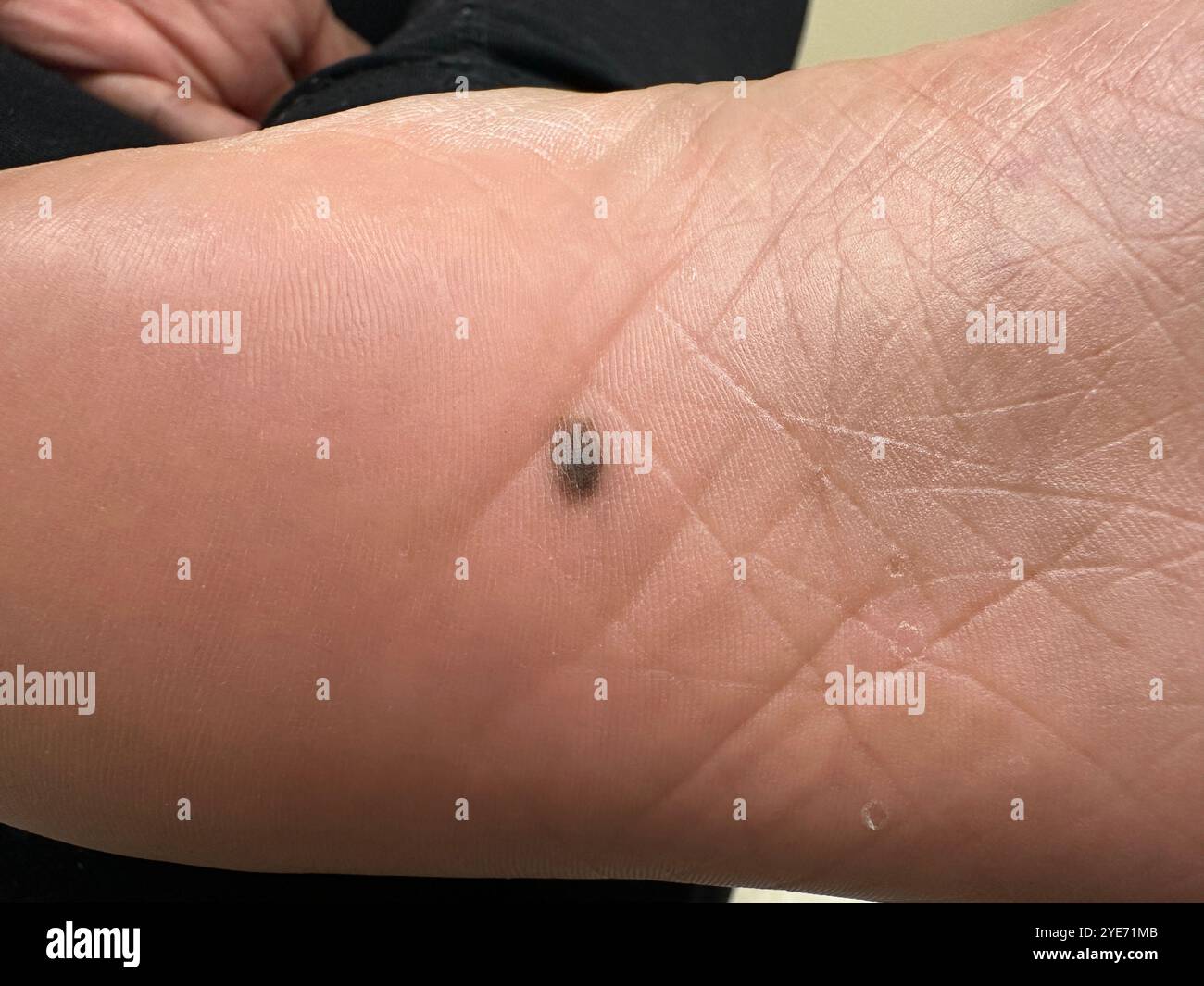 Mole on the sole of a patient's foot. This skin mark is caused by a ...