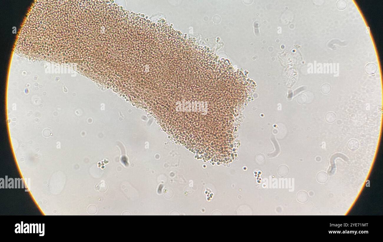 Dermatoscope image of a hair from a 9 year old Hispanic boy with a ...