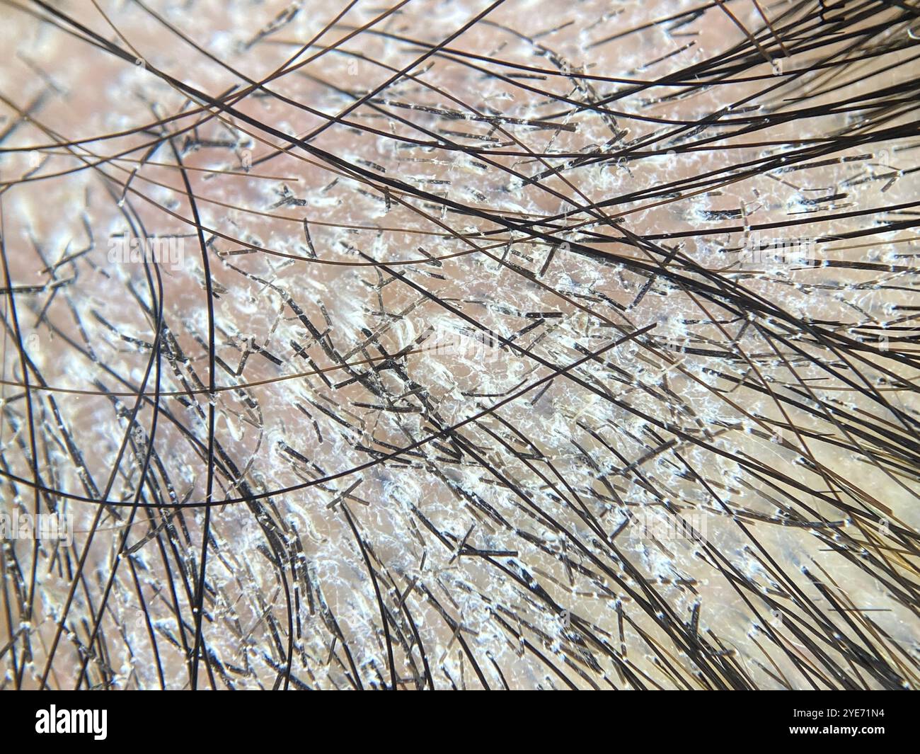 Dermatoscope image of a ringworm infection the scalp of a 9 year old ...