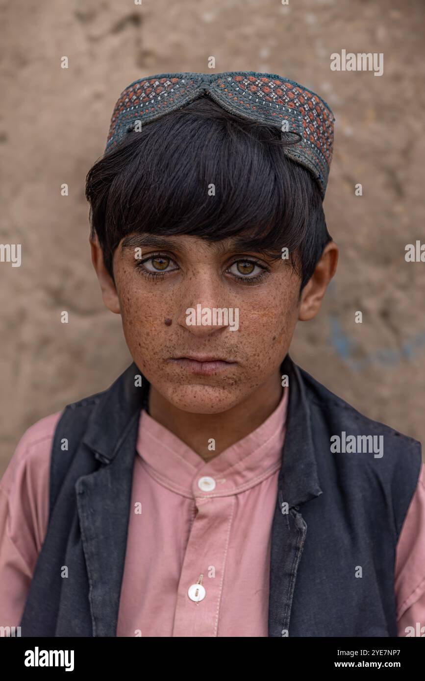 The face of a 10-year-old boy whose skin is damaged in the cold and ...