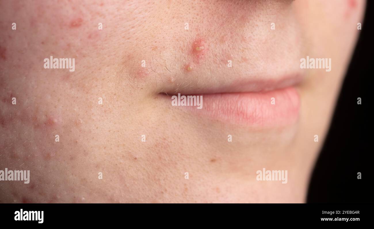 Skin health problem, skin diseases. Skin acne background. Closeup acne ...
