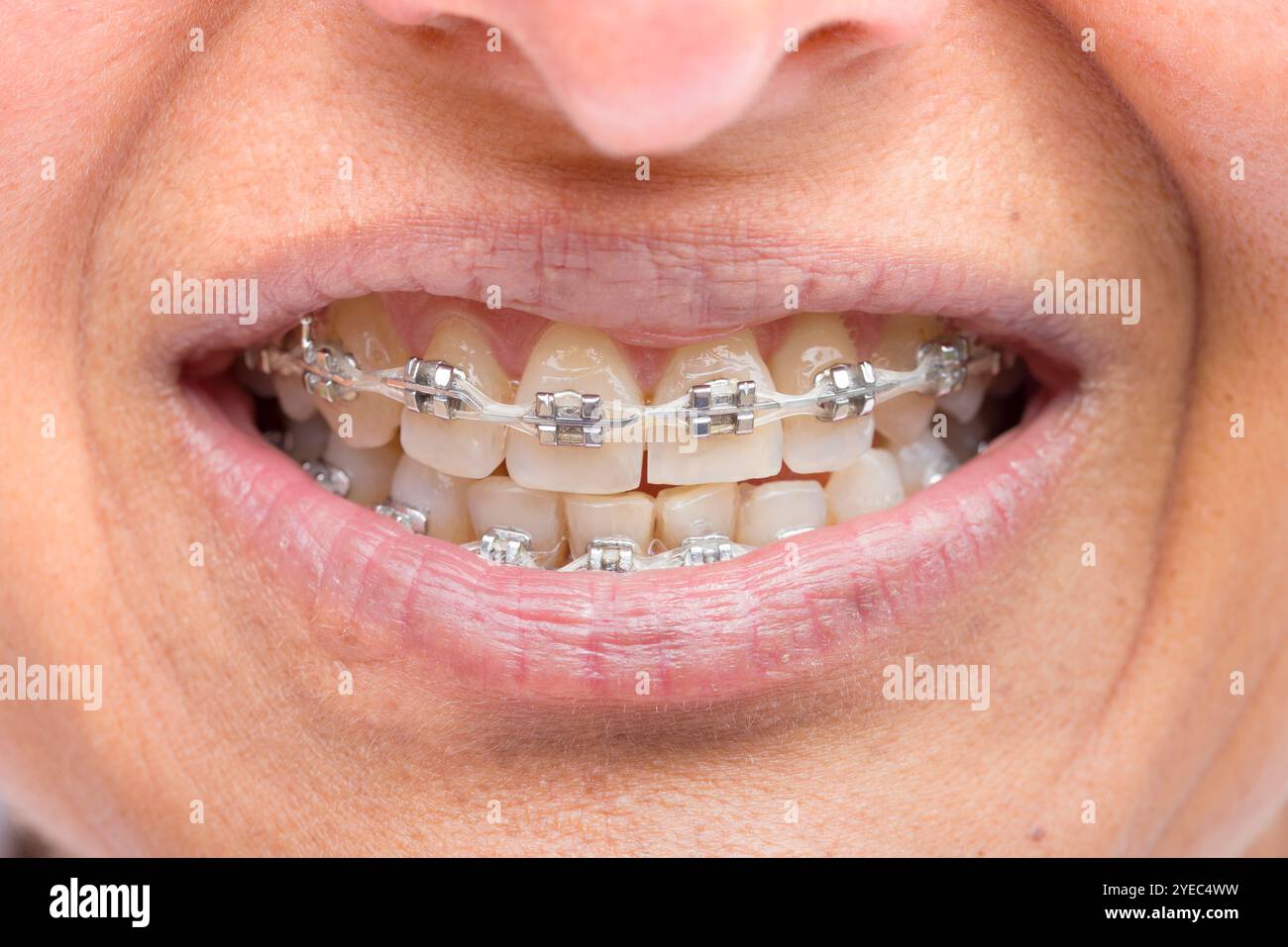Metal braces on teeth of middle age Indian (British Asian) woman, mouth ...