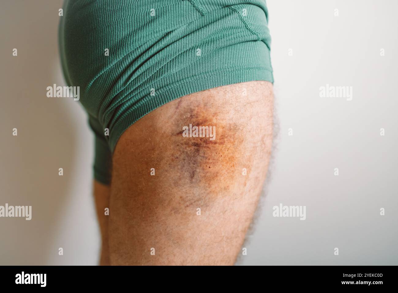 Thigh Injury from a collision, impact or fall, bruised man leg.Very ...