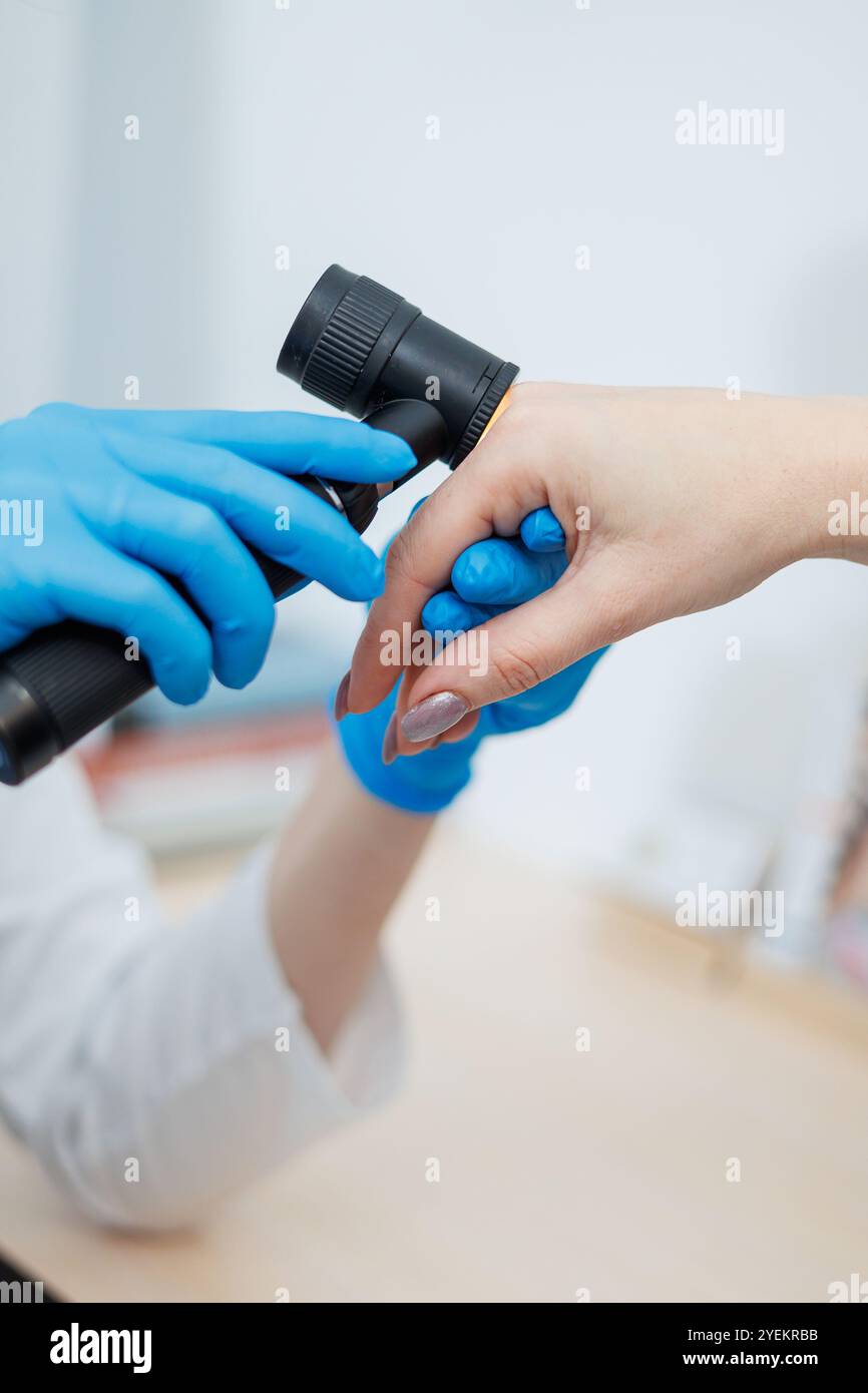 Neoplasm on the skin hi-res stock photography and images - Alamy