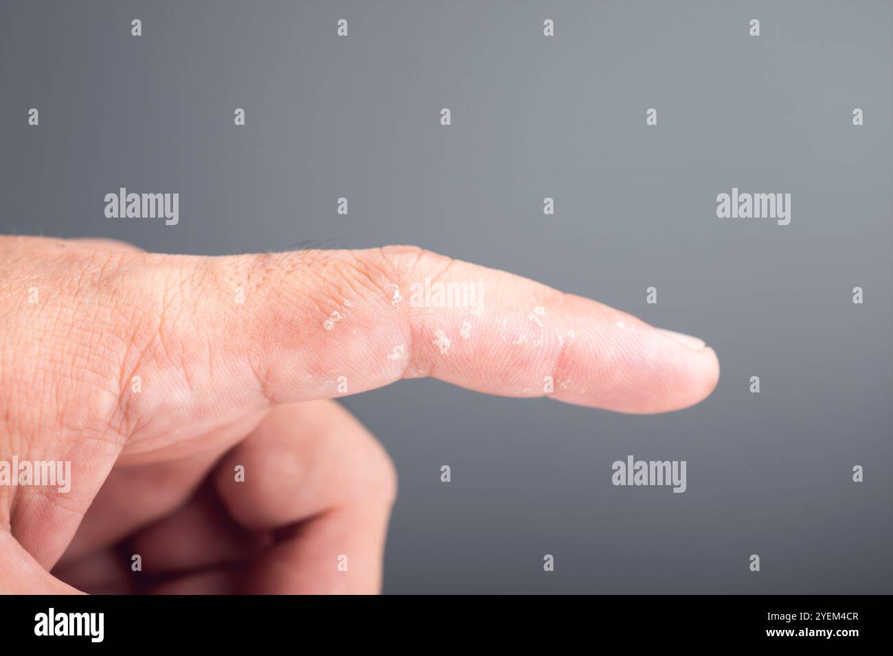 Skinbarrier hi-res stock photography and images - Alamy