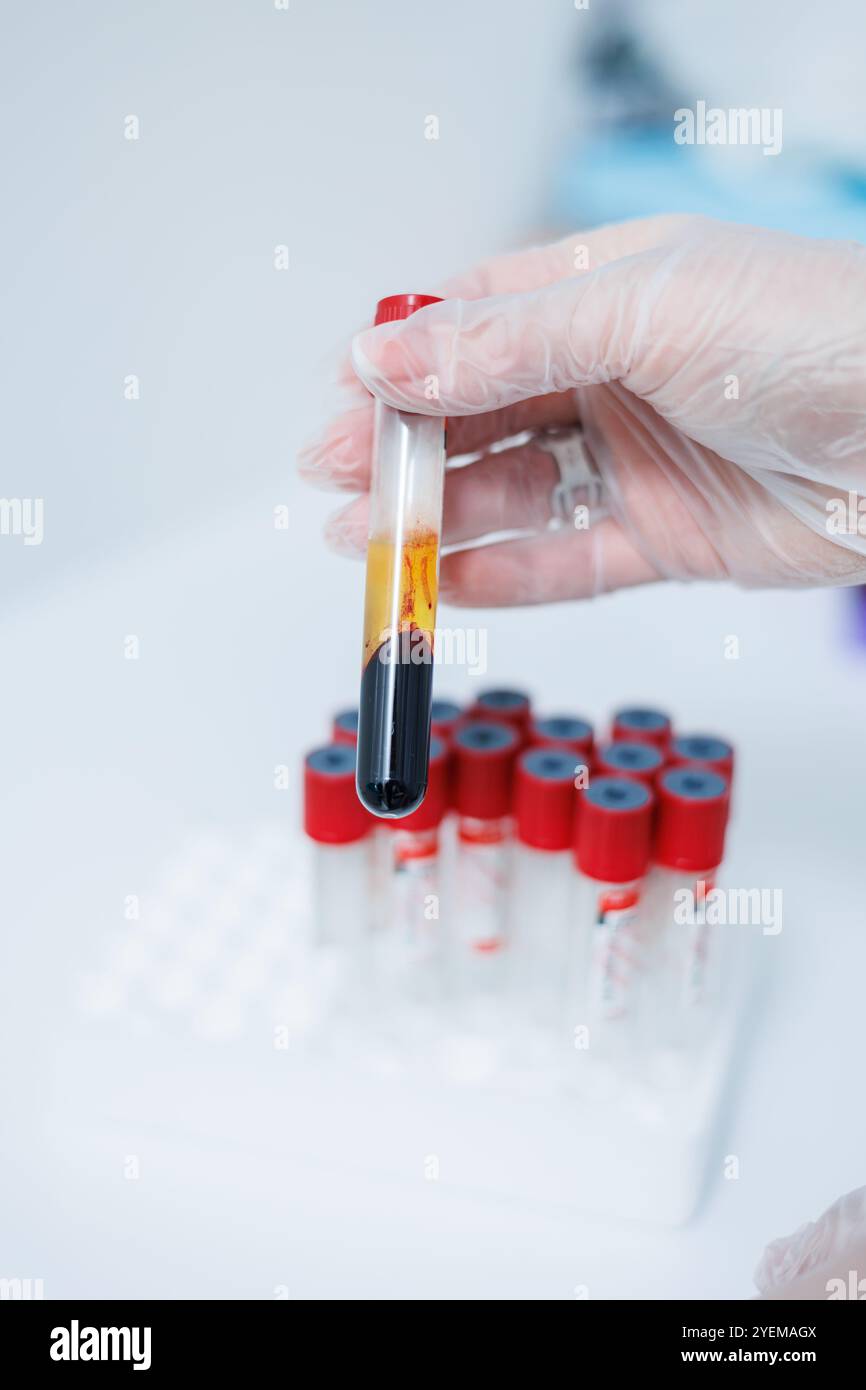Blood is collected in a medical tube for analysis. Blood for medical ...