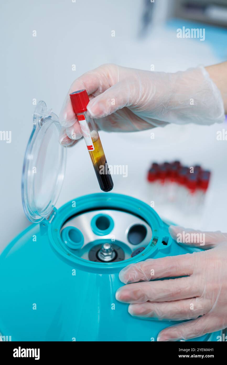 The blood in the test tube is placed in a centrifuge for plasma therapy ...