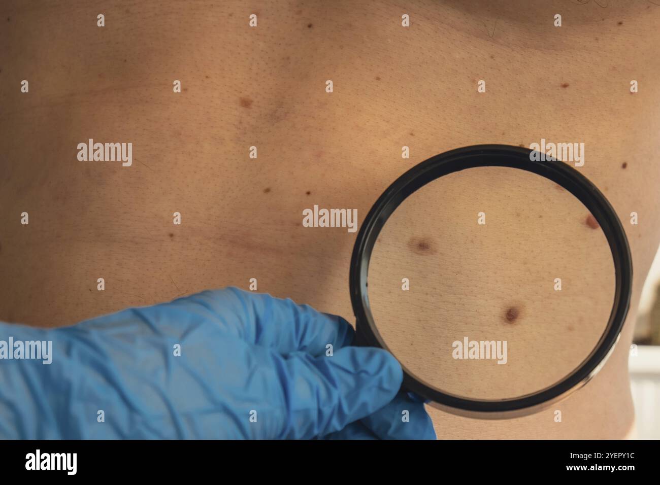 Unrecognizable Dermatologist examining patient's birthmark with ...