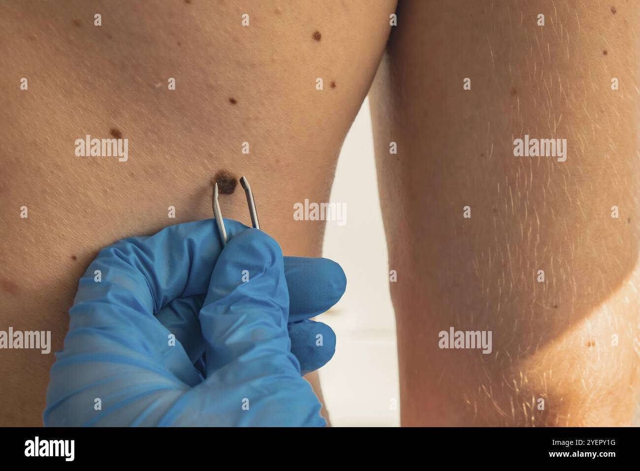 Doctor in medical gloves examining man skin mole for size ...