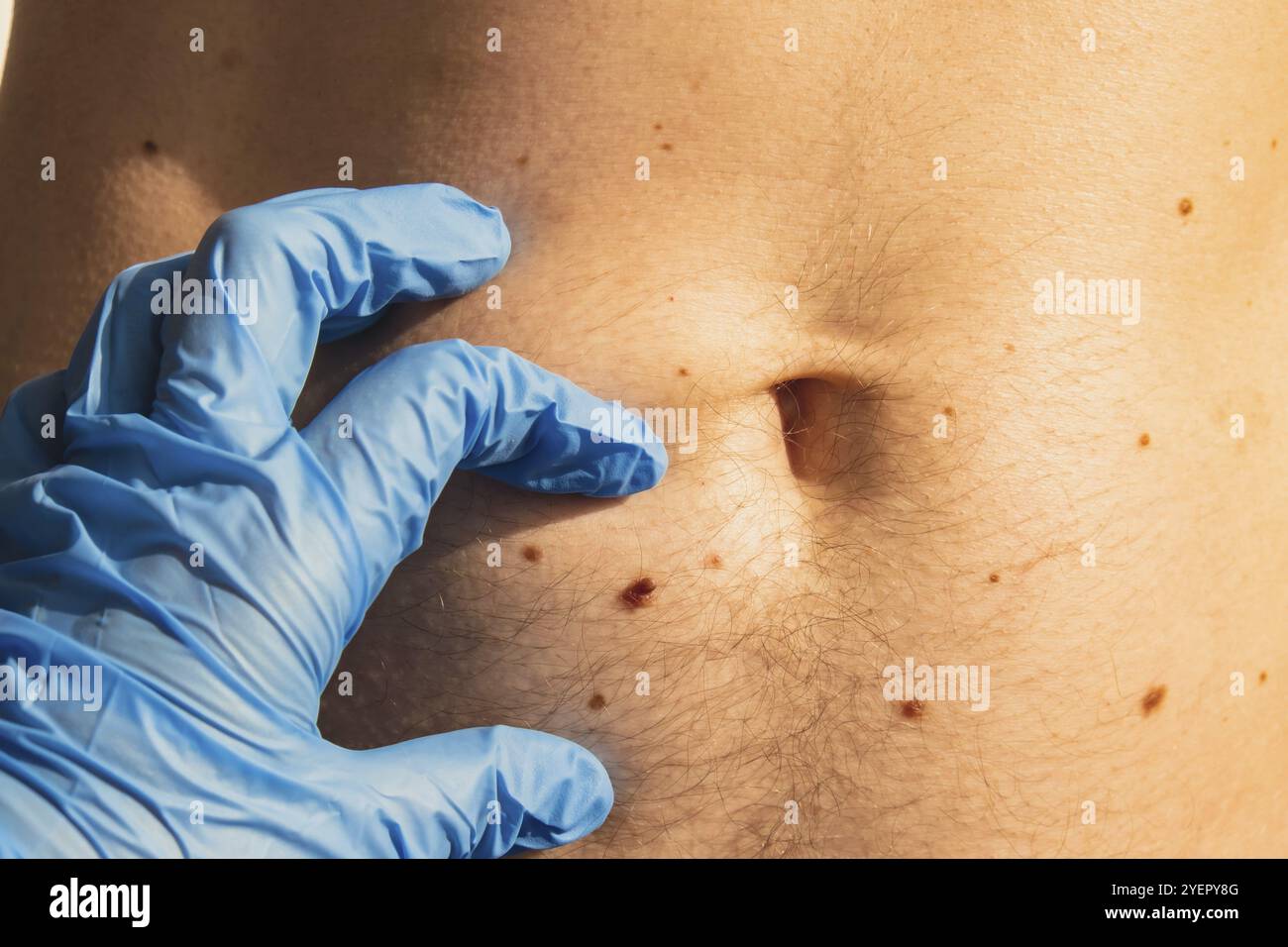 Dermatologist checking male birthmarks. Doctor in medical gloves ...