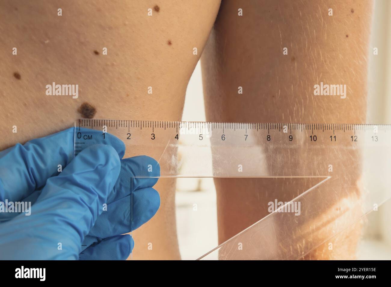Dermatologist checking sizes of male birthmarks with ruler. Doctor ...