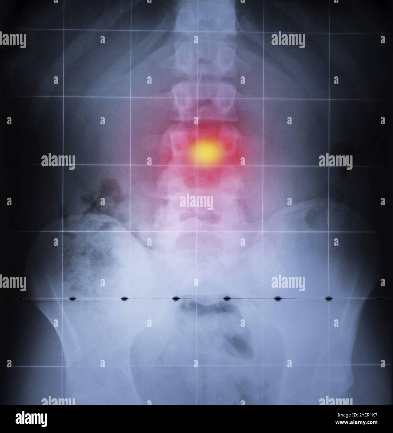 X ray, Spine and pelvis of human body. Back pain highlighted in red ...