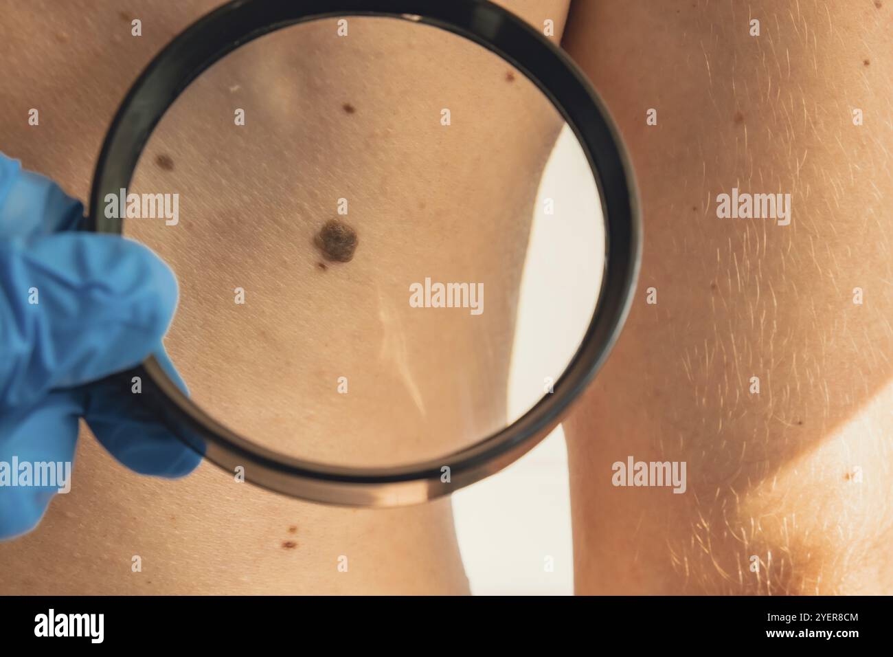 Mole dermoscopy, preventive of melanoma. Dermatologist examining ...