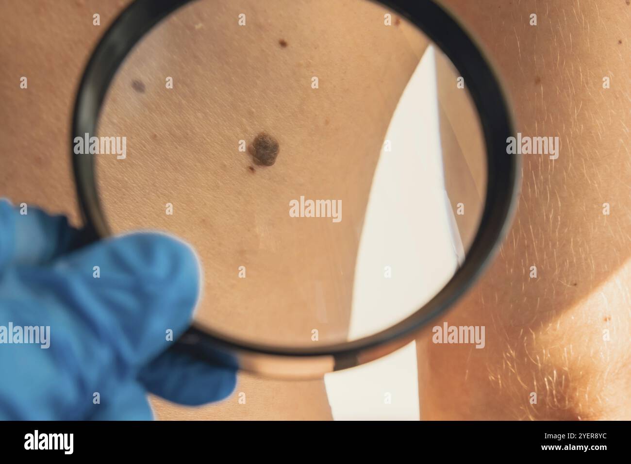 Mole dermoscopy, preventive of melanoma. Dermatologist examining ...
