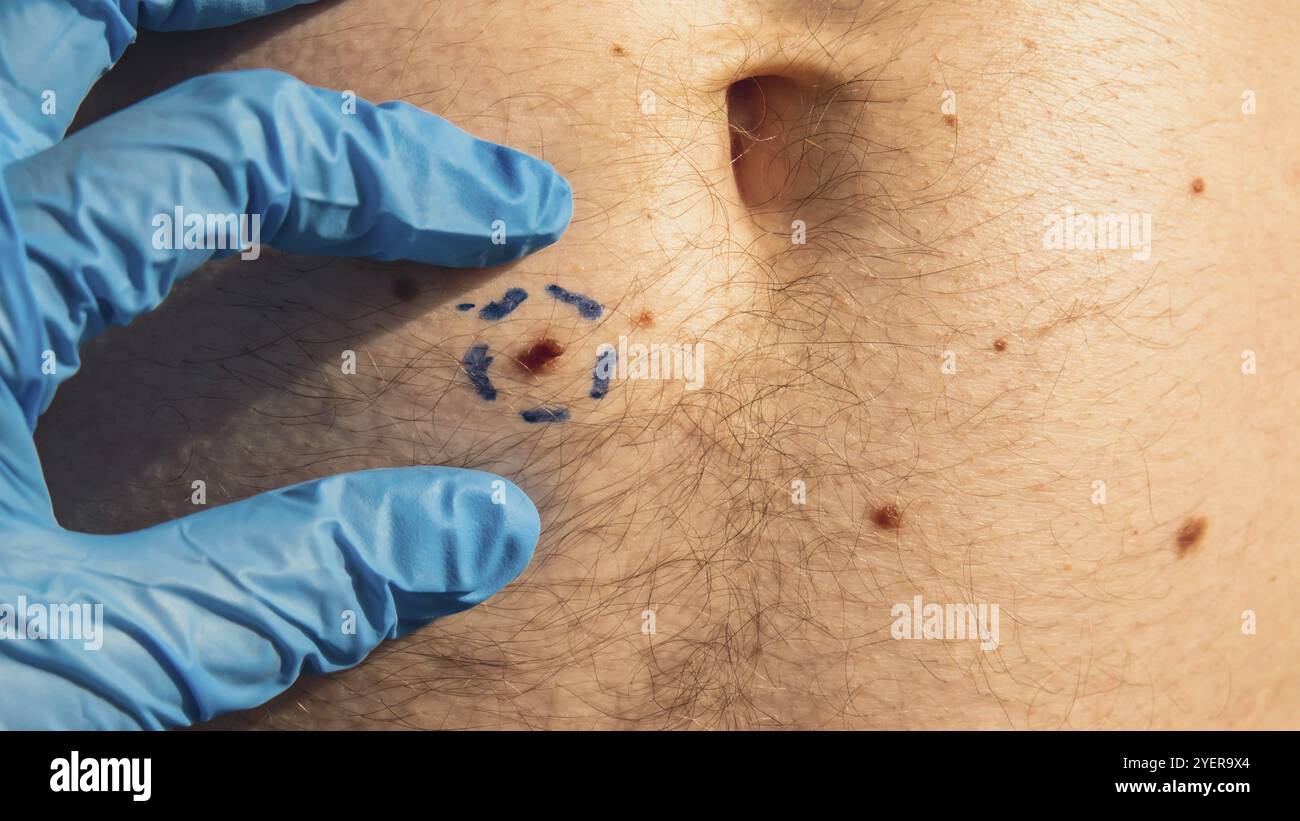 Doctor in medical gloves paint lines around male birthmarks. Preparing ...
