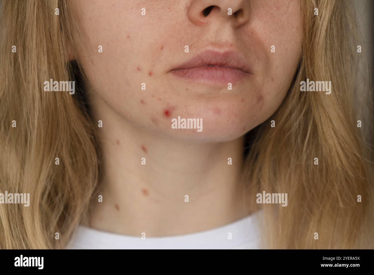 Unrecognizable woman showing her acne on face. Close-up acne on woman's ...