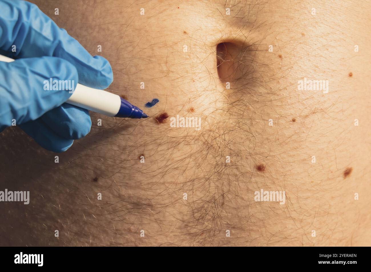 Preparing procedure for medical skin surgery. Unrecognizable Doctor in ...