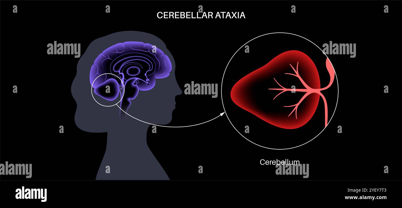 Conceptual illustration of cerebellar ataxia. Ataxia is disorder that ...