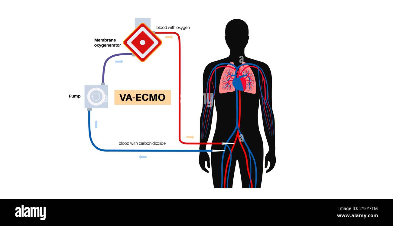 Conceptual illustration of extracorporeal membrane oxygenation. This ...
