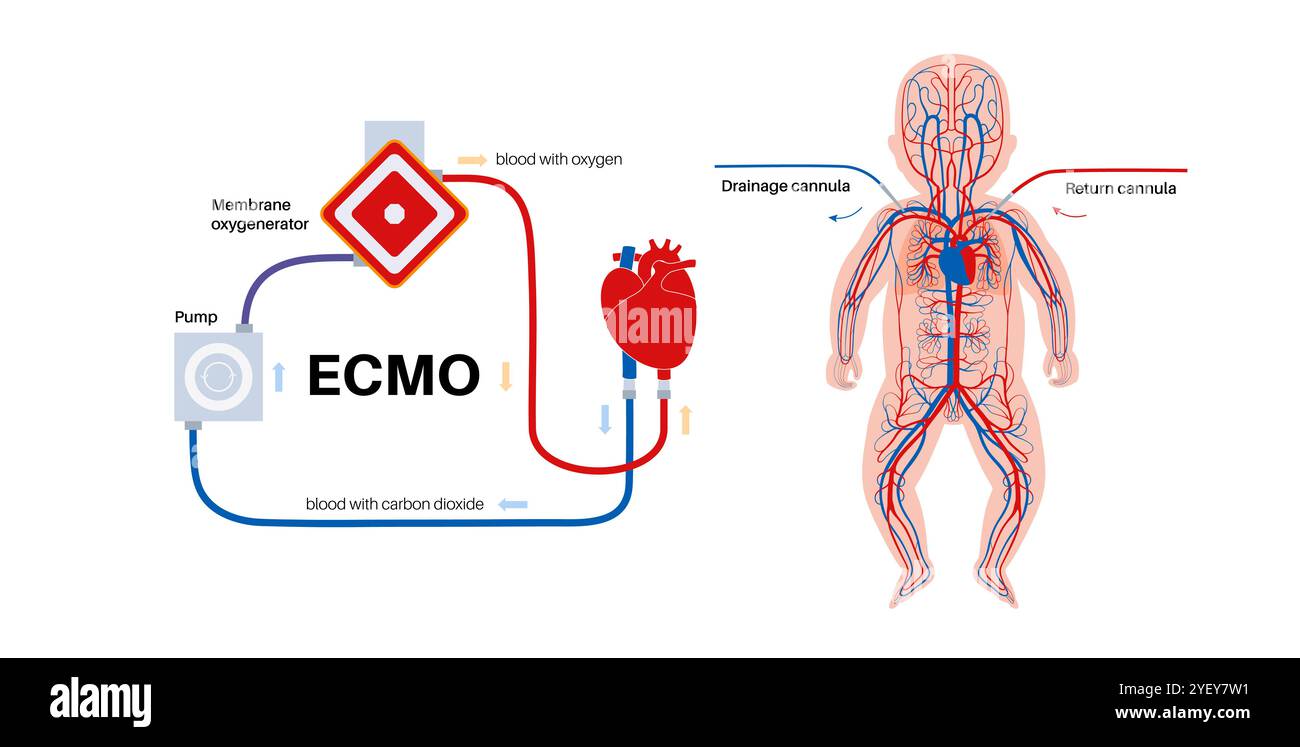 Conceptual illustration of extracorporeal membrane oxygenation. This ...