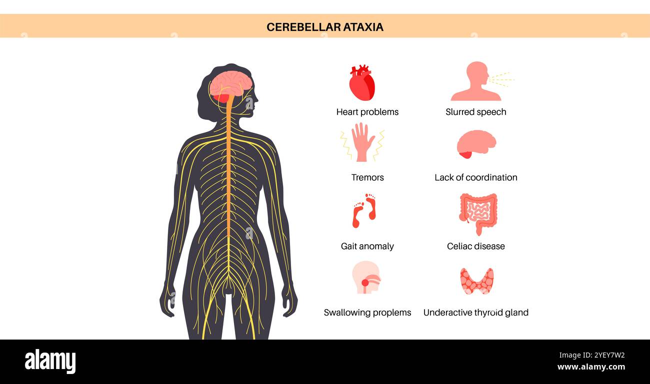 Conceptual illustration of cerebellar ataxia. Ataxia is disorder that ...