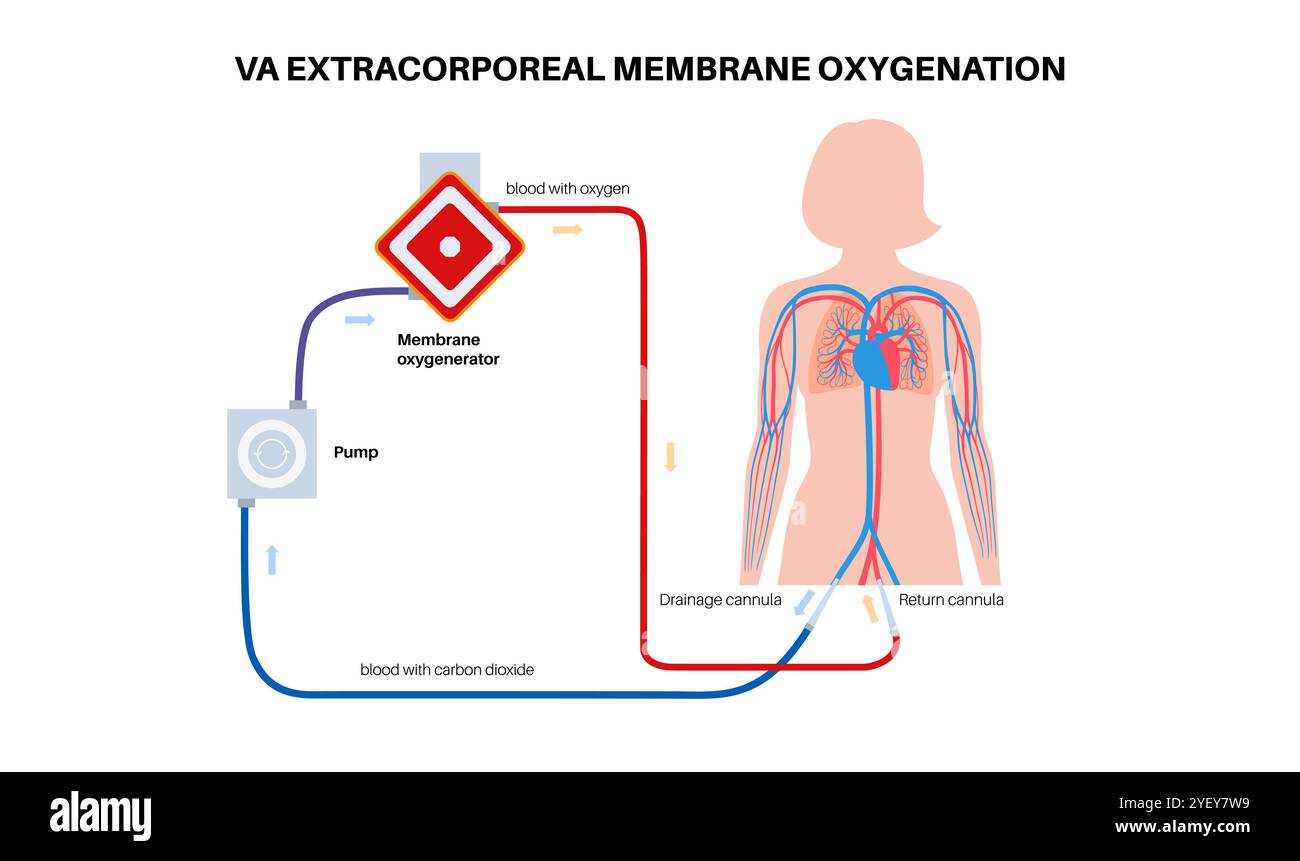 Conceptual illustration of extracorporeal membrane oxygenation. This artificial mechanical ...