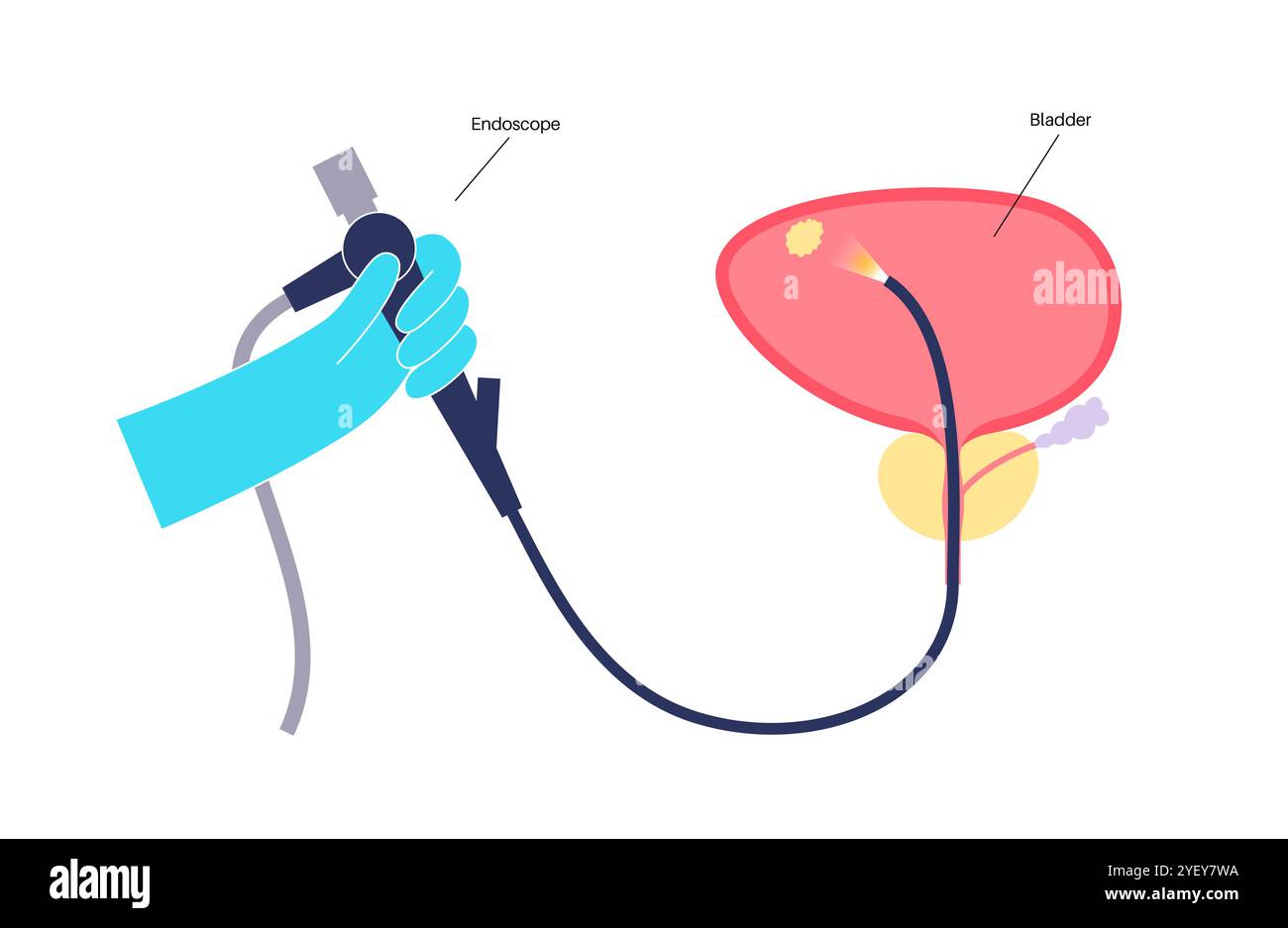 Conceptual illustration of a cystoscopy procedure. This is a procedure used to diagnose, monitor ...