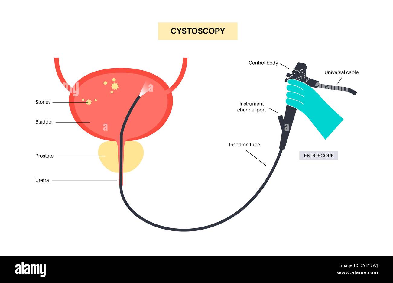 Conceptual illustration of a cystoscopy procedure. This is a procedure used to diagnose, monitor ...