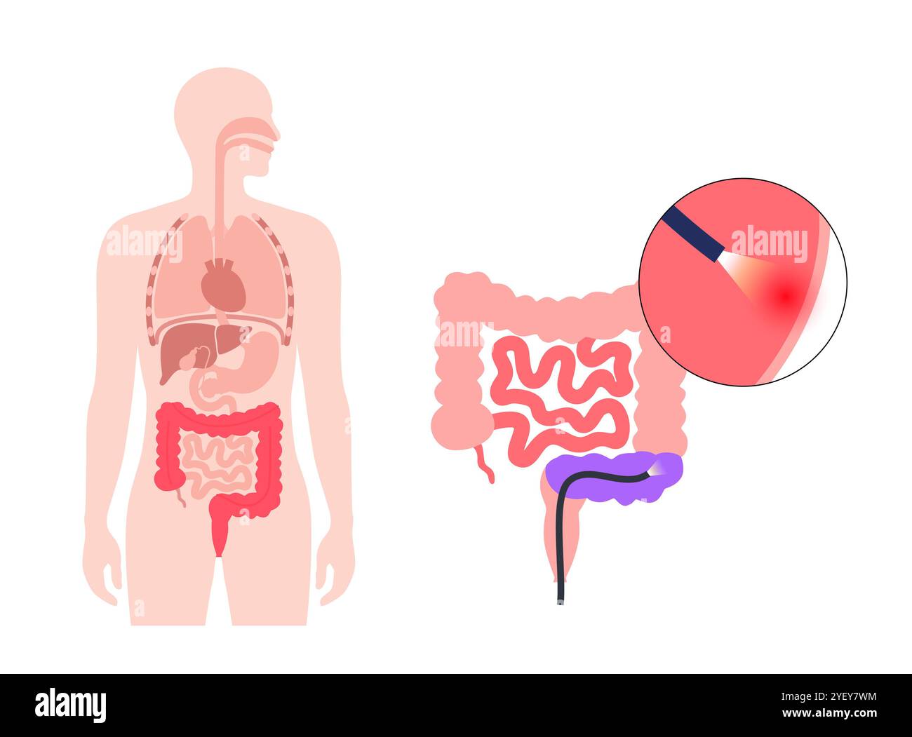 Conceptual illustration of a sigmoidoscopy procedure. This is a ...